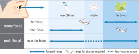 Intraocular Lenses (IOLs): Types and differences